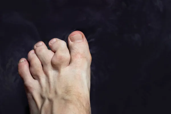 Everything You Need to Know About Claw Toes: Causes, Symptoms, and ...